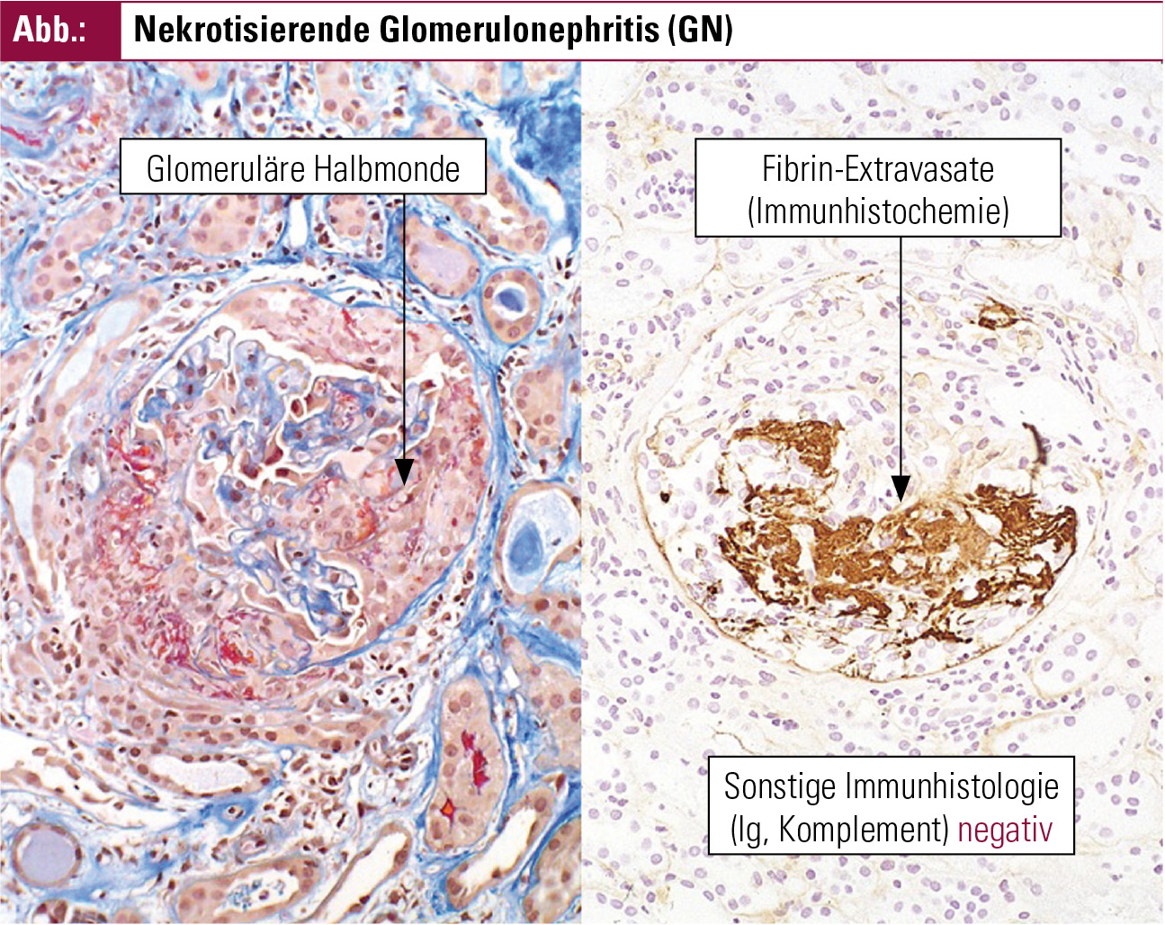 Wegenersche Granulomatose Wegener Granulomatose | Granulomatöse